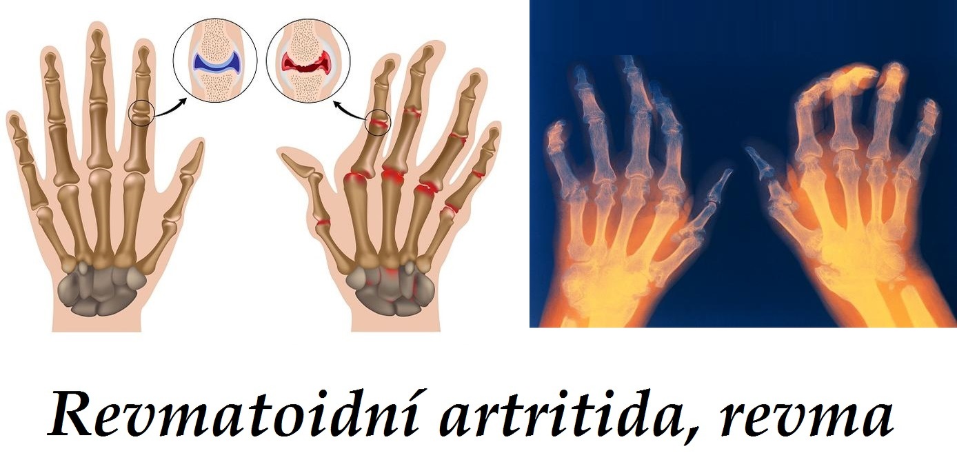 Revma, revmatismus, revmatoidní artritida - byliny, bylinky, babské ...
