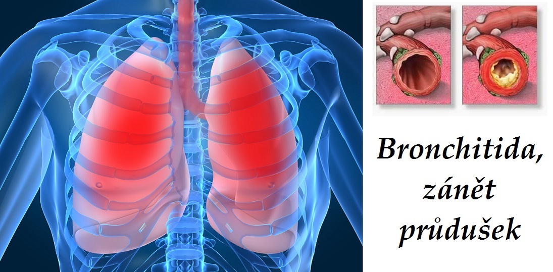 Zánět průdušek, bronchitida, zahlenění - byliny, bylinky, babské rady ...